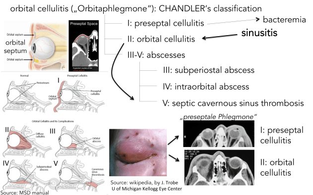 preseptal and orbital cellulitis (“präseptale und Orbitaphlegmone ...